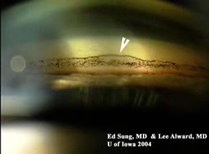 Medicine Decoded: Various Lines in Ophthalmology
